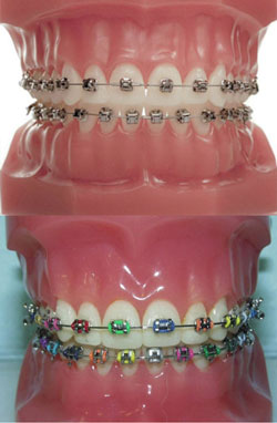 Damon Smile Federal Way WA | Cascade Orthodontics